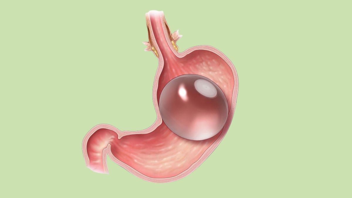 All You Need to Know About Orbera Balloon